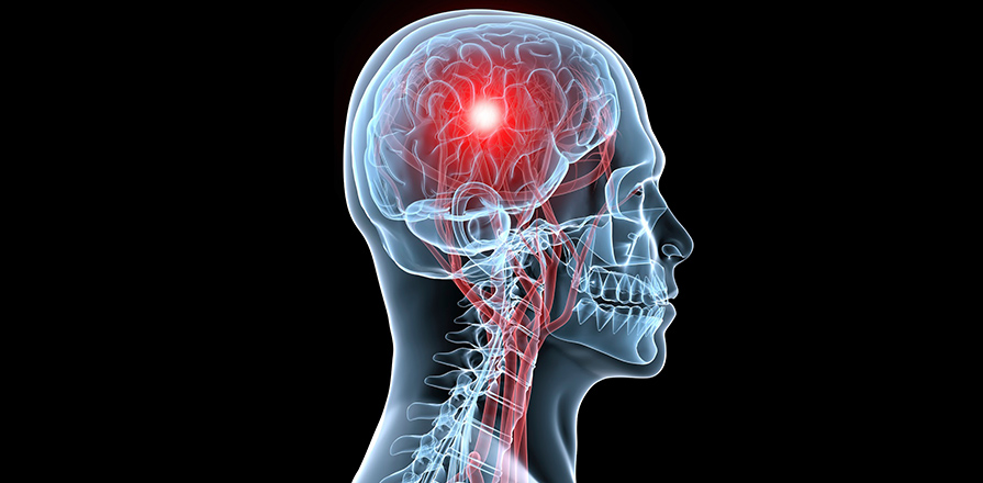 Different strokes? Varying stroke outcomes for men and women point ...